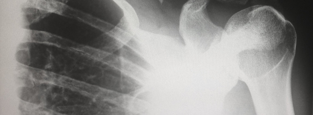 Anyone For Sore Ribs! No, I Didn’t Mean Short Ribs!